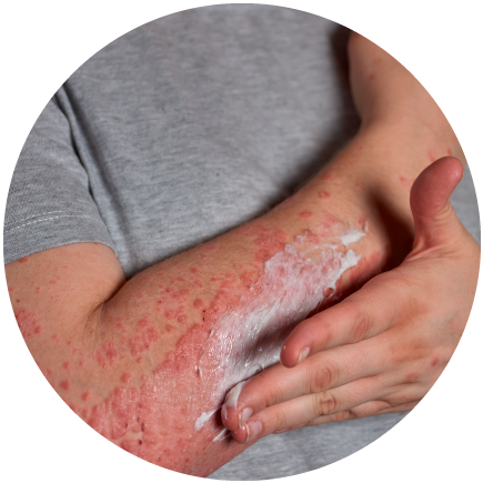 Psoriasis - Tratamientos | Novartis